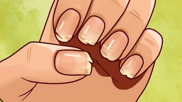 Brittle nails: 6 tips to strengthen them naturally – GRANDMA’S TRICKS